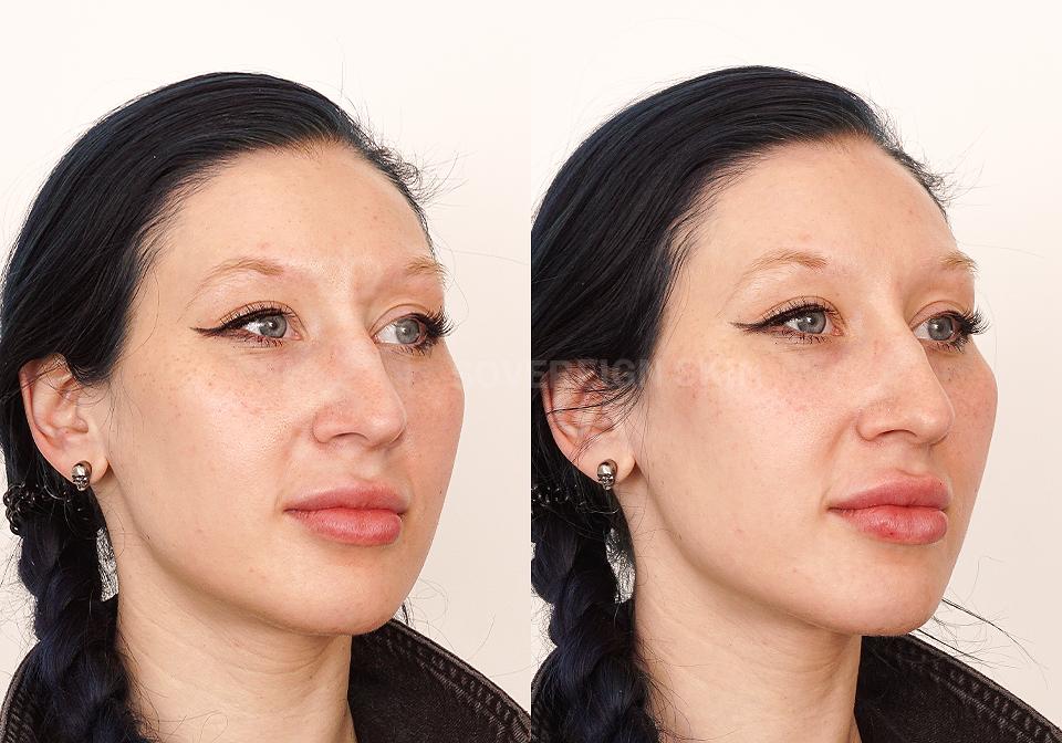 Cheek Fillers Before & After Gallery at Sovereign Skin in Toronto