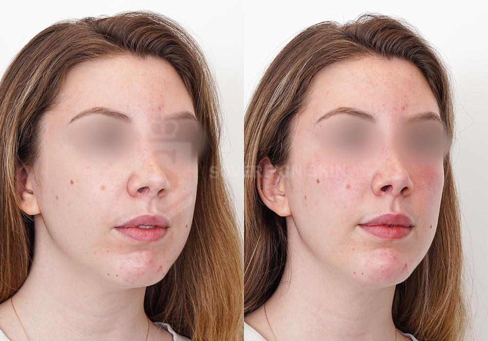 Cheek Fillers Before & After Gallery at Sovereign Skin in Toronto