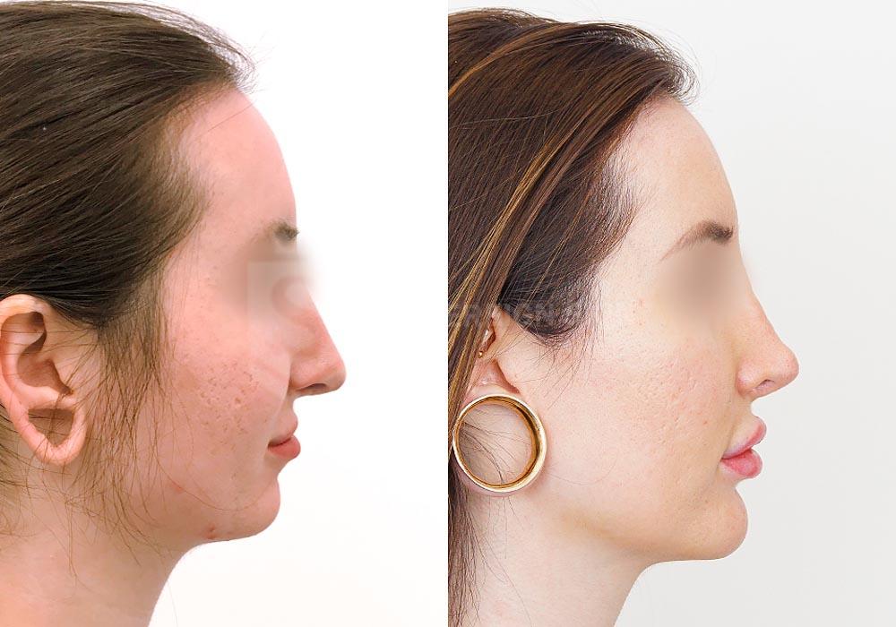 Chin Injectable Before & After Gallery at Sovereign Skin in Toronto