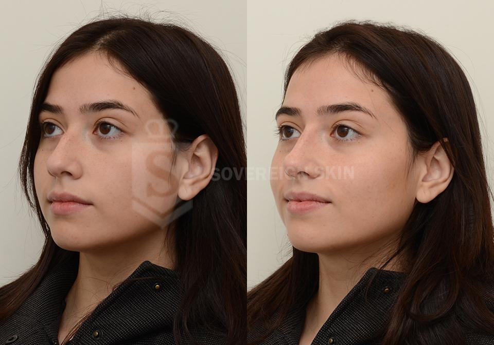 Non Surgical Nose Job Before & After Gallery at Sovereign Skin in Toronto