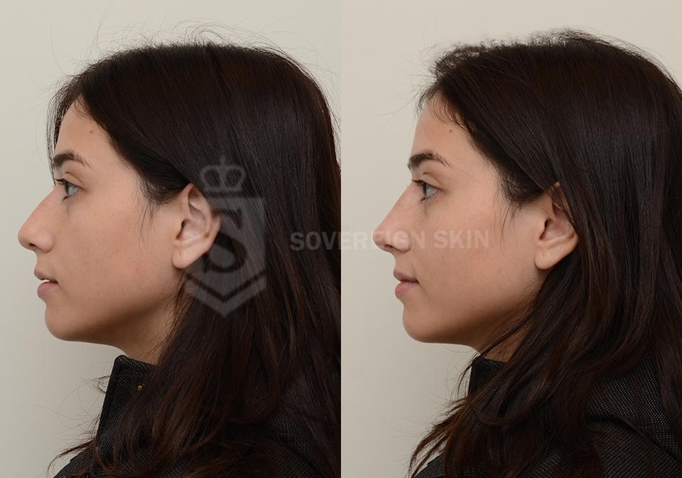 Non Surgical Nose Job Before & After Gallery at Sovereign Skin in Toronto