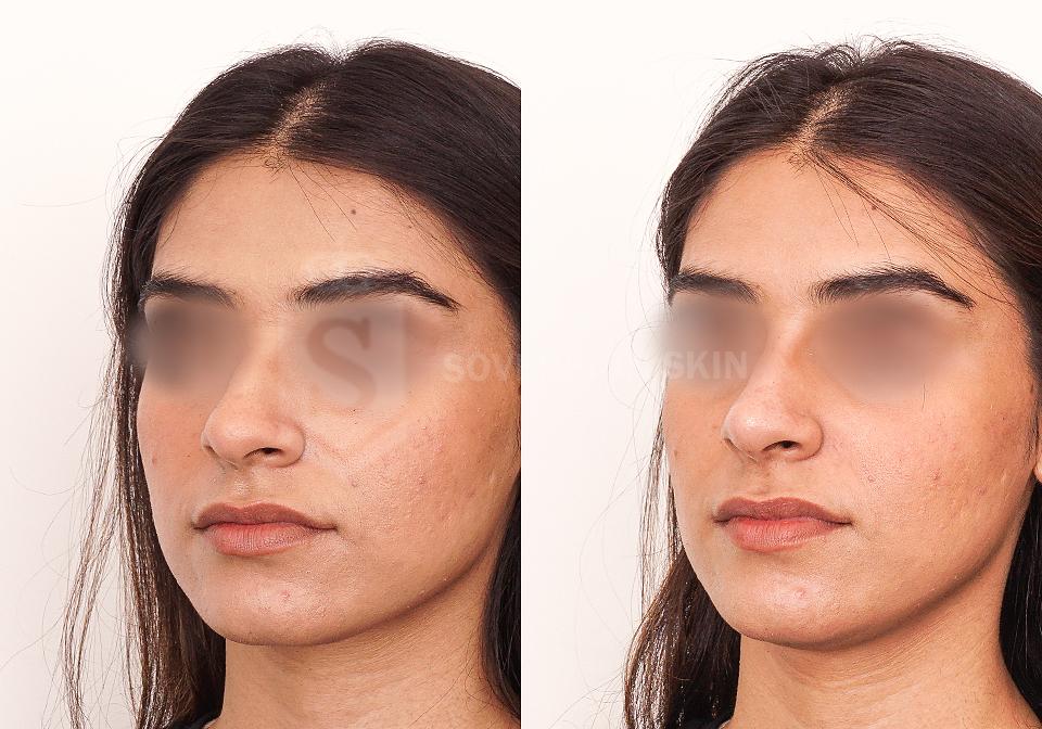Non Surgical Nose Job Before & After Gallery at Sovereign Skin in Toronto