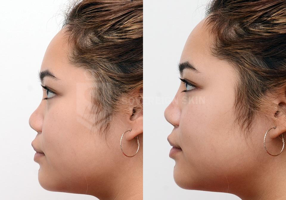 Non Surgical Nose Job Before & After Gallery at Sovereign Skin in Toronto