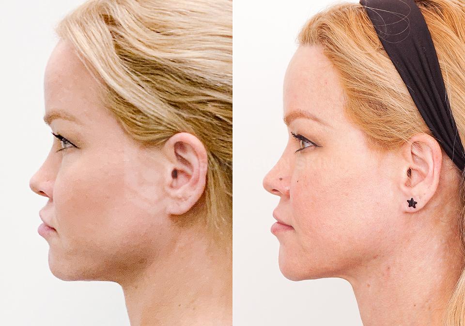 Thread Lifts Before & After Gallery at Sovereign Skin in Toronto