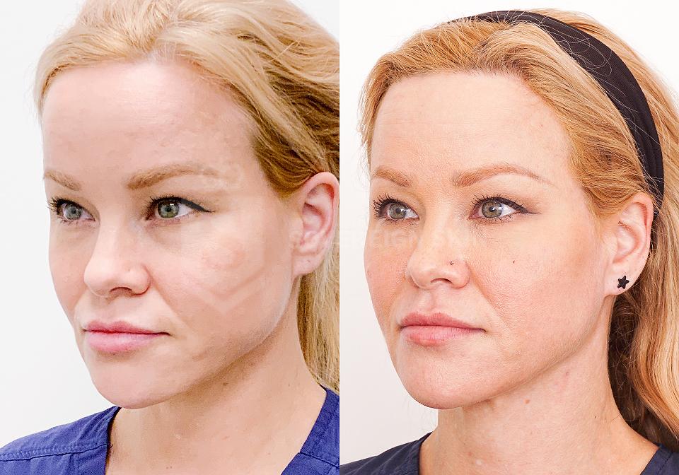 Thread Lifts Before & After Gallery at Sovereign Skin in Toronto