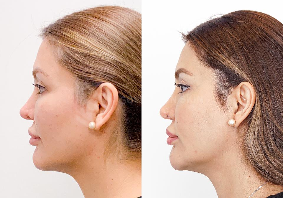 Thread Lifts Before & After Gallery at Sovereign Skin in Toronto