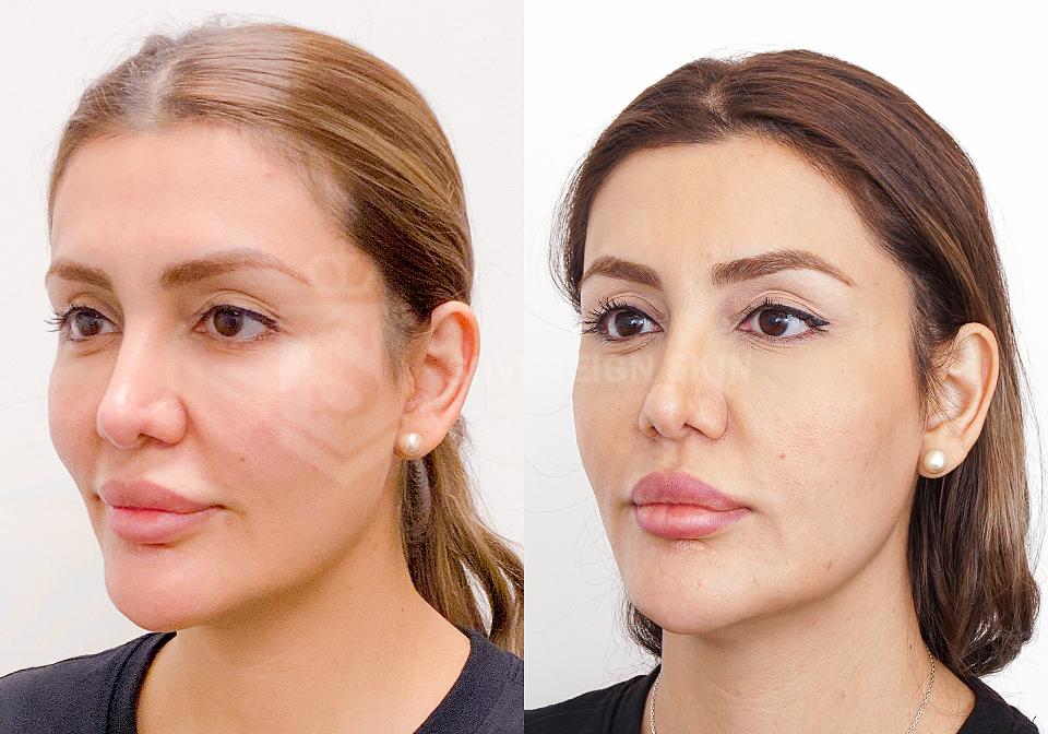 Thread Lifts Before & After Gallery at Sovereign Skin in Toronto
