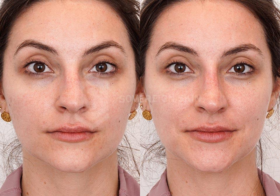 Non Surgical Nose Job Before & After Gallery at Sovereign Skin in Toronto