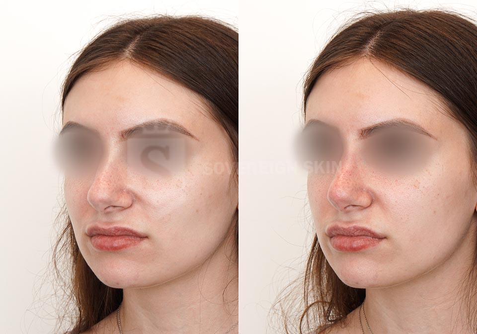 Non Surgical Nose Job Before & After Gallery at Sovereign Skin in Toronto