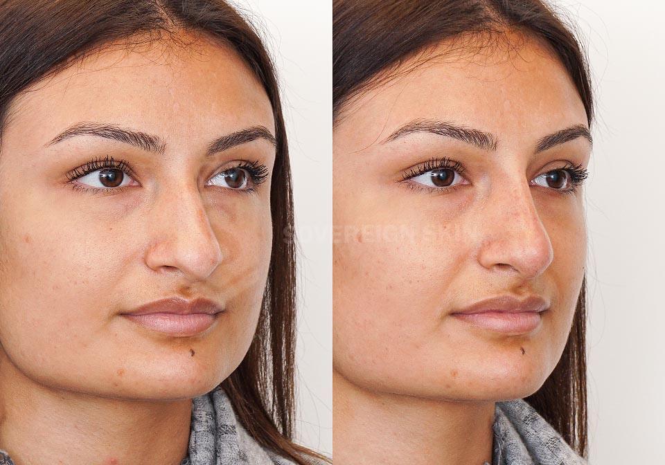 Non Surgical Nose Job Before & After Gallery at Sovereign Skin in Toronto