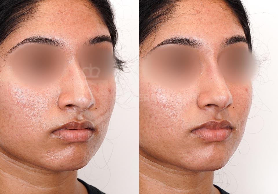 Non Surgical Nose Job Before & After Gallery at Sovereign Skin in Toronto