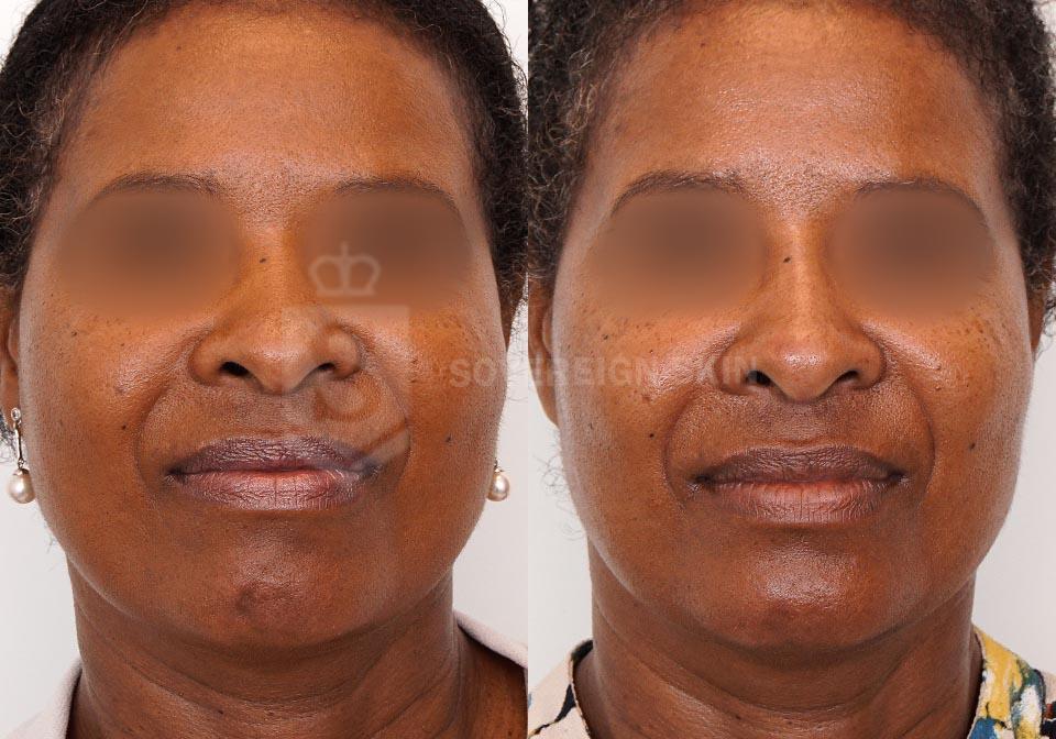 Non Surgical Nose Job Before & After Gallery at Sovereign Skin in Toronto
