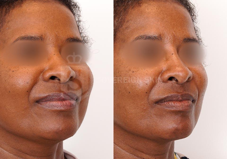 Non Surgical Nose Job Before & After Gallery at Sovereign Skin in Toronto