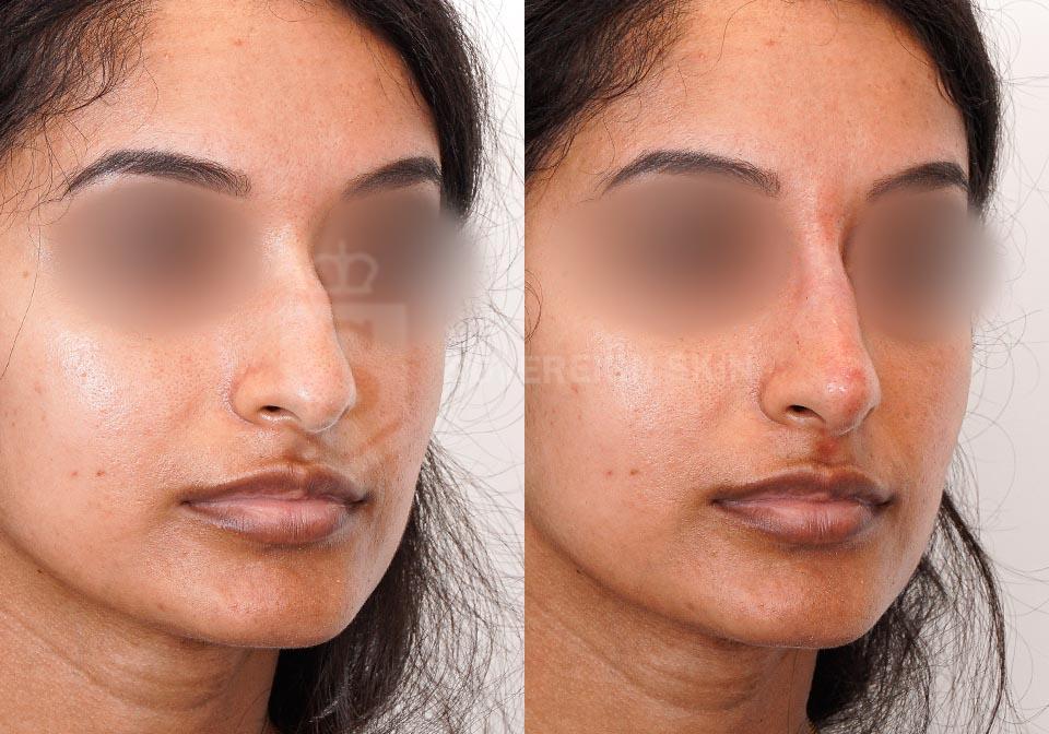 Non Surgical Nose Job Before & After Gallery at Sovereign Skin in Toronto