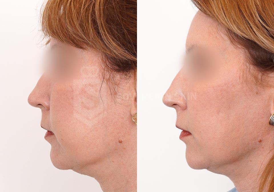 Thread Lifts Before & After Gallery at Sovereign Skin in Toronto