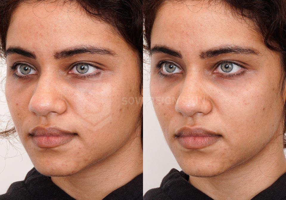 Cheek Fillers Before & After Gallery at Sovereign Skin in Toronto