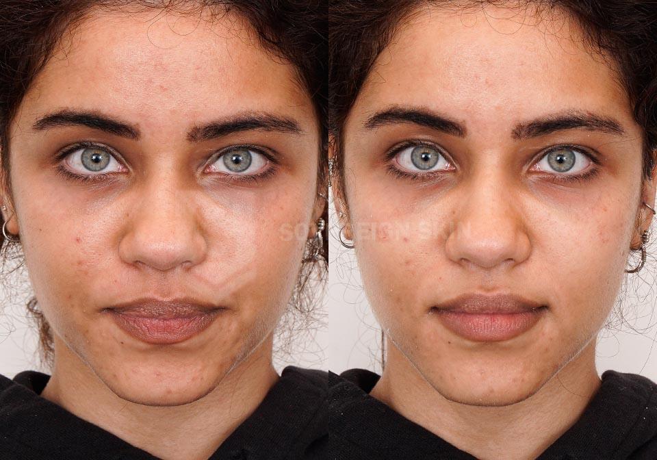 Cheek Fillers Before & After Gallery at Sovereign Skin in Toronto