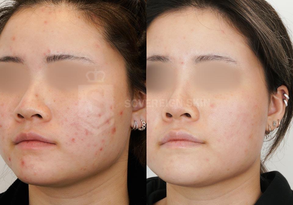 Laser Acne Treatment Before & After Gallery at Sovereign Skin in Toronto