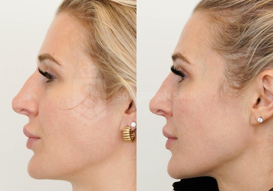 Cheek Fillers Before & After Gallery at Sovereign Skin in Toronto