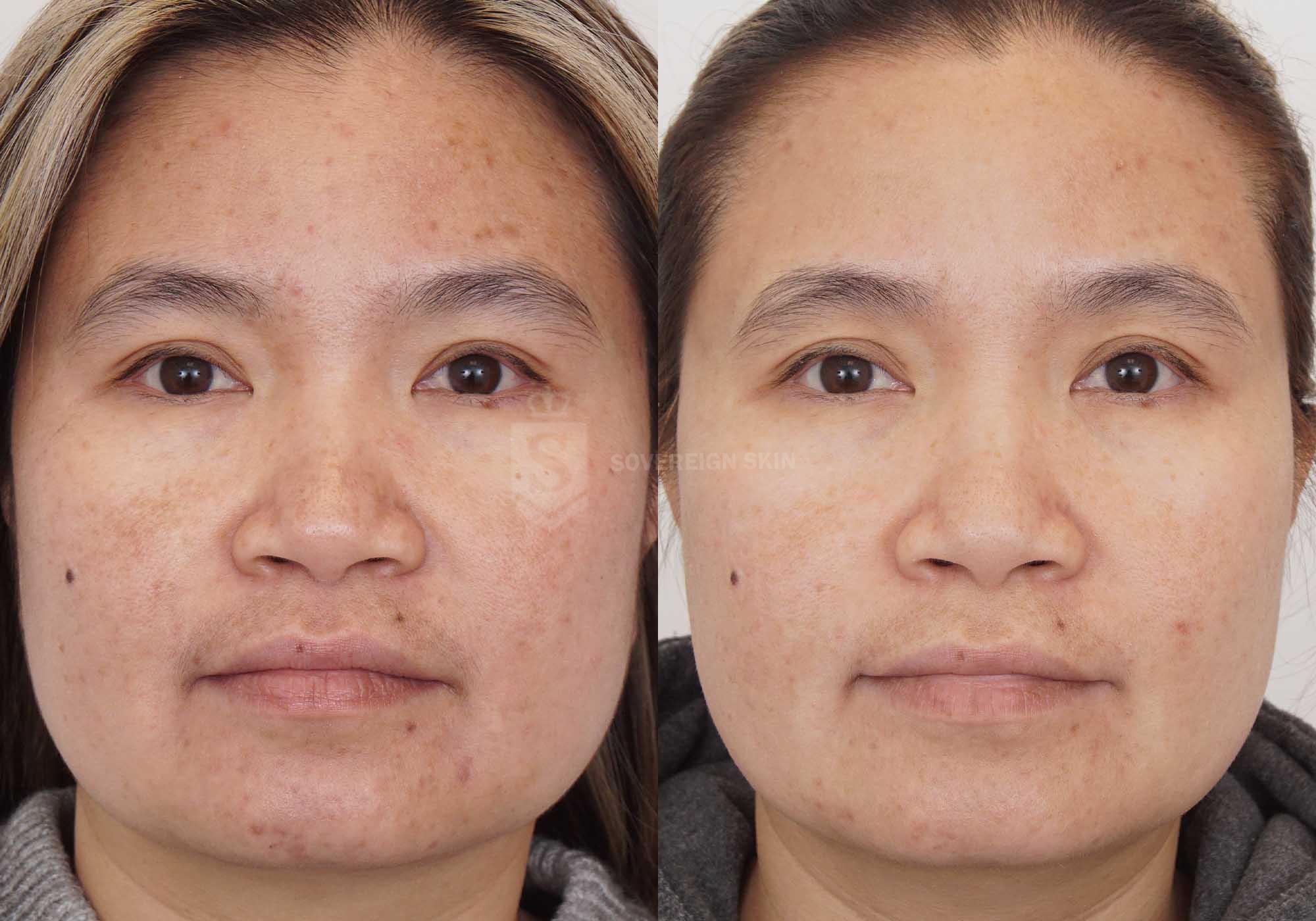 Laser Angel Brightening Before & After Gallery at Sovereign Skin in Toronto