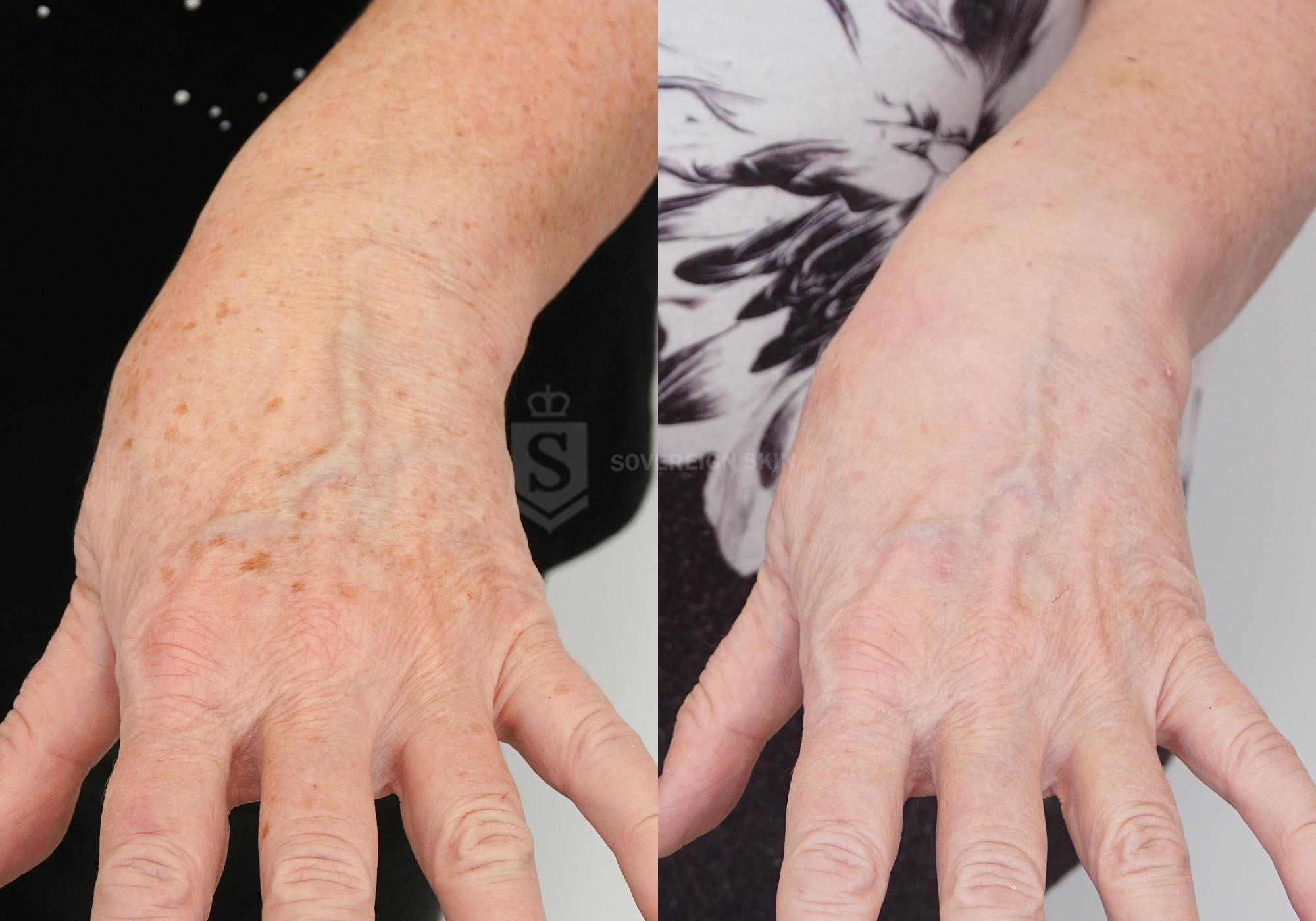Laser IPL Before & After Gallery at Sovereign Skin in Toronto