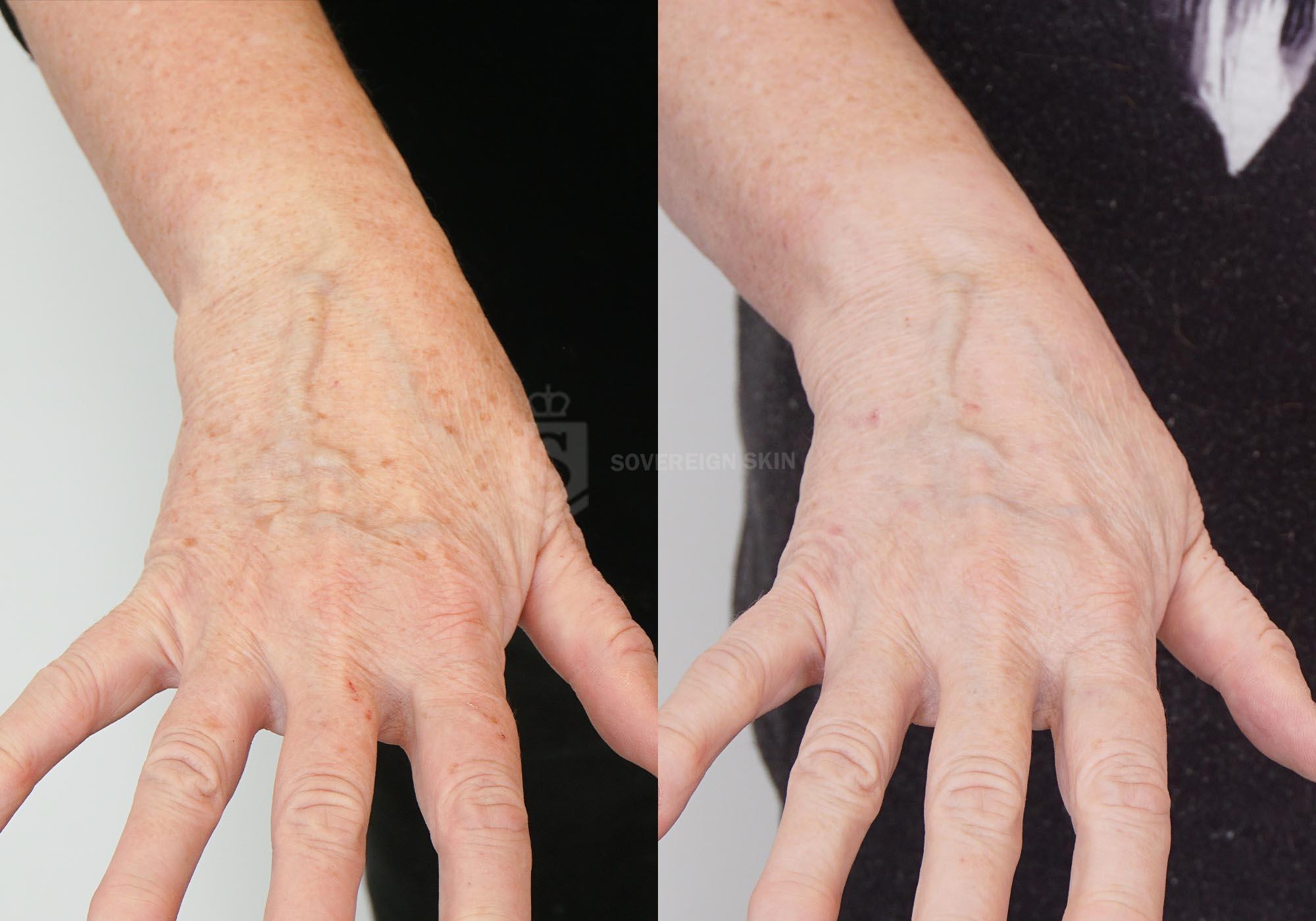 Laser IPL Before & After Gallery at Sovereign Skin in Toronto