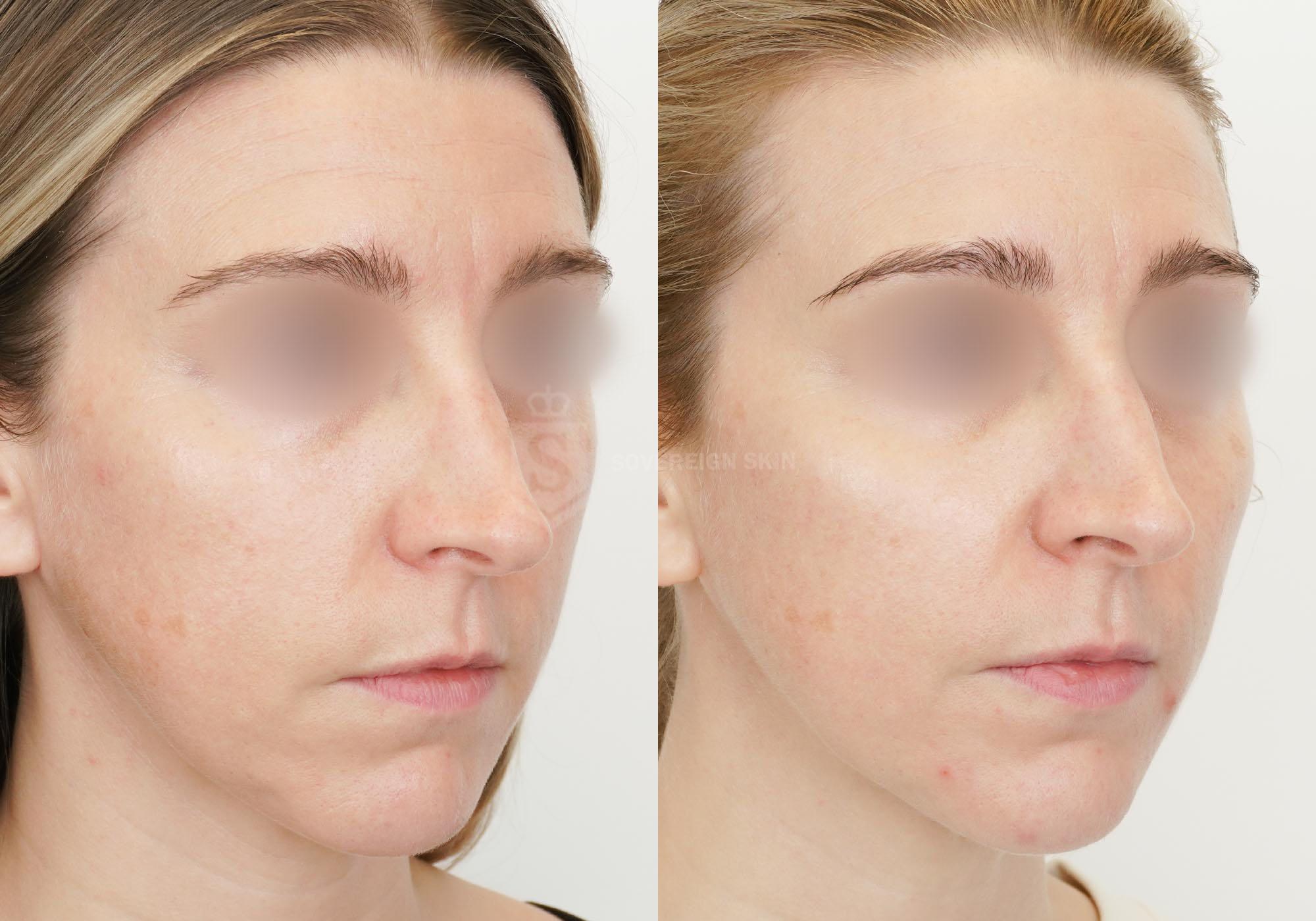 Cheek Fillers Before & After Gallery at Sovereign Skin in Toronto