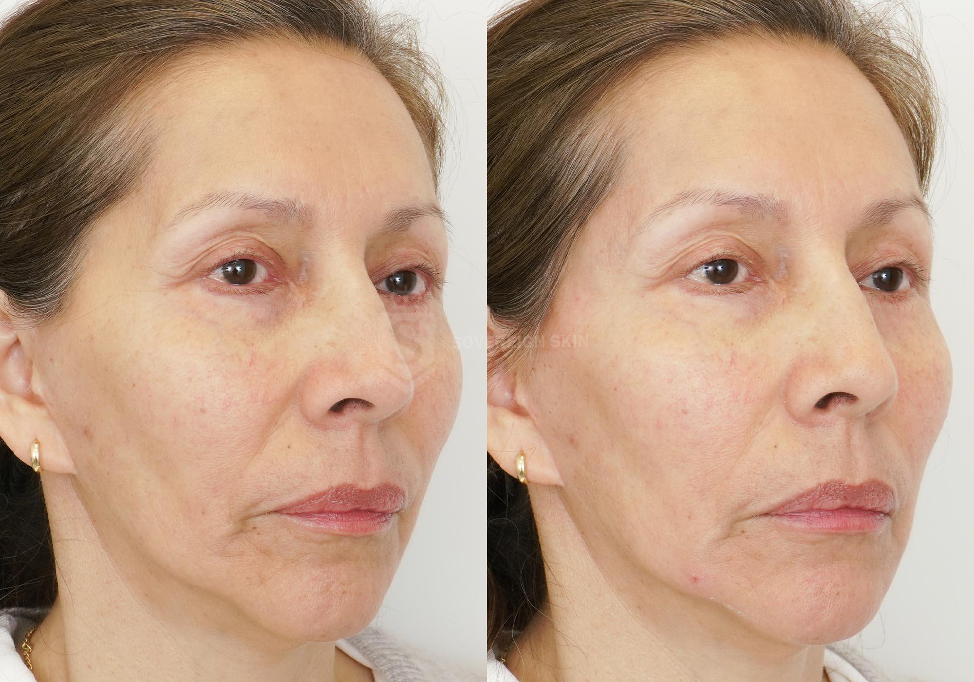 Nasolabial Folds Filler Before & After Gallery at Sovereign Skin in Toronto