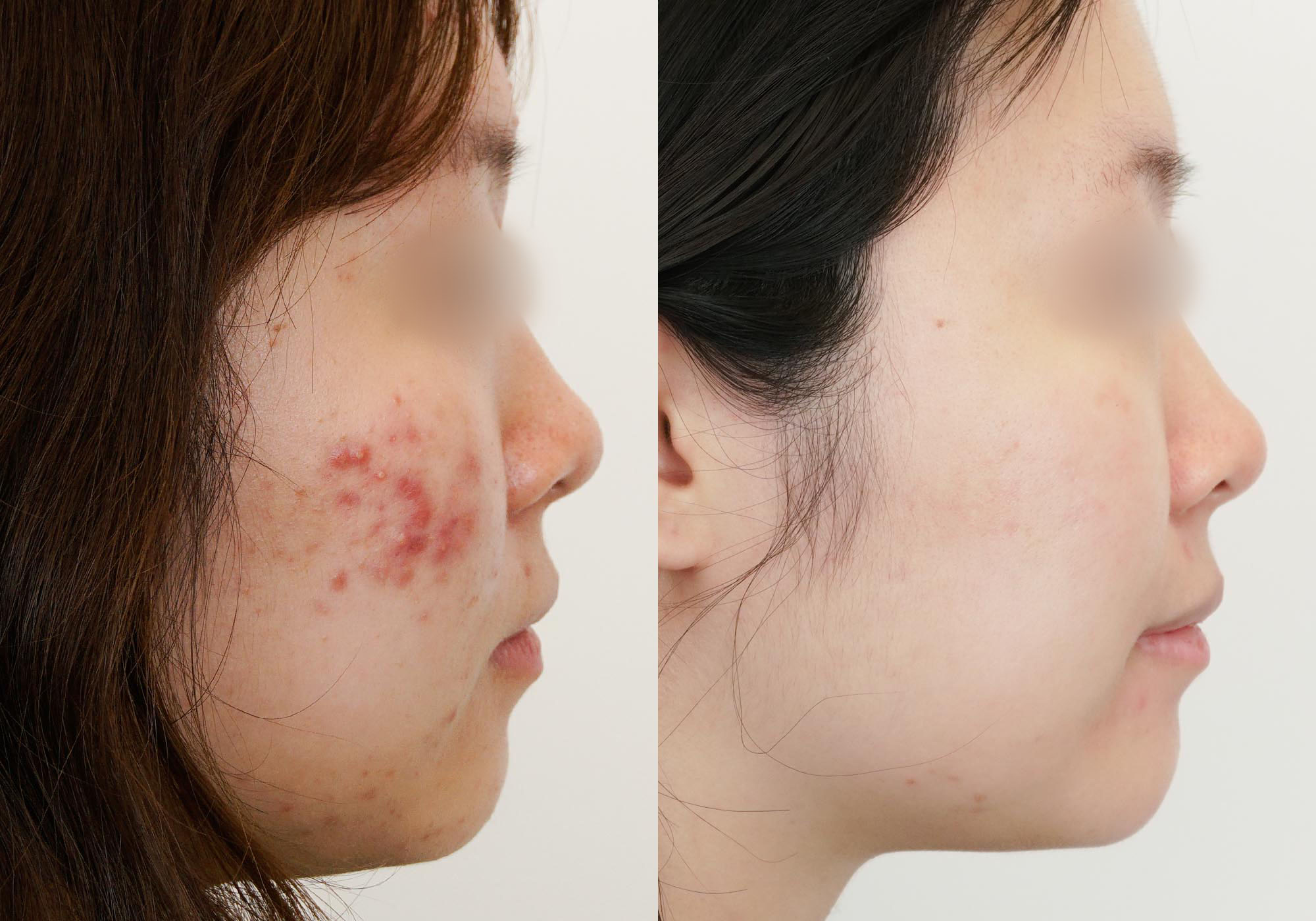 SilkPeel Before & After Gallery at Sovereign Skin in Toronto