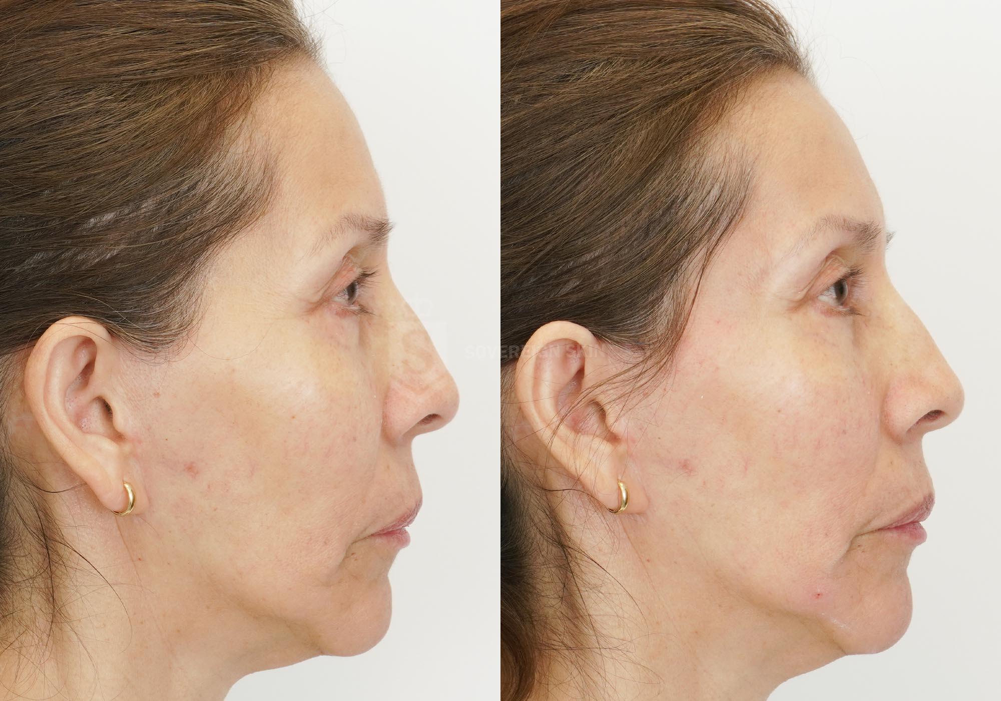 Temples Filler Before & After Gallery at Sovereign Skin in Toronto